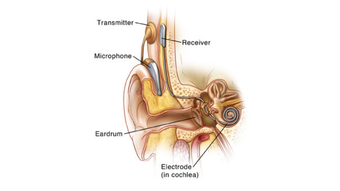Auditory Brainstem Implant vs Cochlear Implant: Combining Treatment Technologies